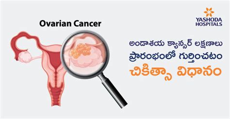 Ovarian Cancer Early Signs Detection And Treatment Yashoda