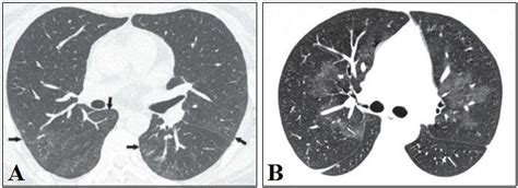 Ground Glass Pattern A Axial Hrct Chest Image Shows Bilateral Areas