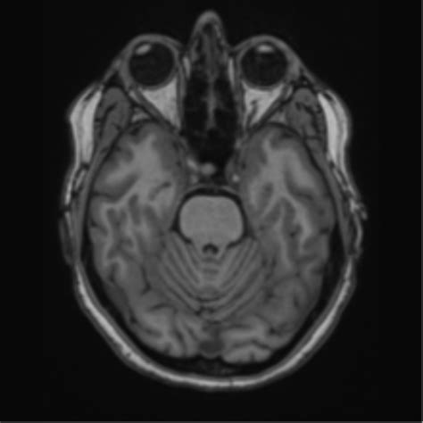 Cavernoma With Bleed Midbrain Radiopaedia 54546 60774 Axial T1 Nc
