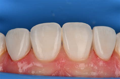 Semi Freehand Composite Peg Lateral Restorations
