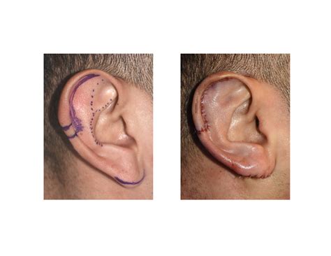 Combining Vertical Ear Reduction With Setback Otoplasty Explore
