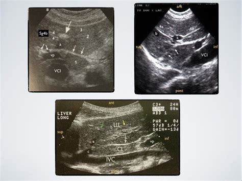 Cuadernos De Anatomía Quirúrgica Segmentación Hepática En Ecografía