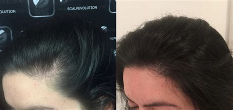 Scalp Micropigmentation For Scars Scalp Evolution