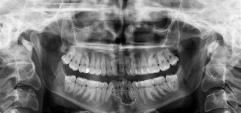 Periapical Abscess Radiograph Preoperative Radiograph Of Tooth 46