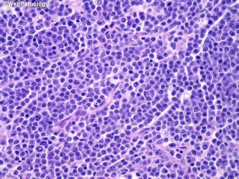 B Cell Prolymphocytic Leukemia Differential