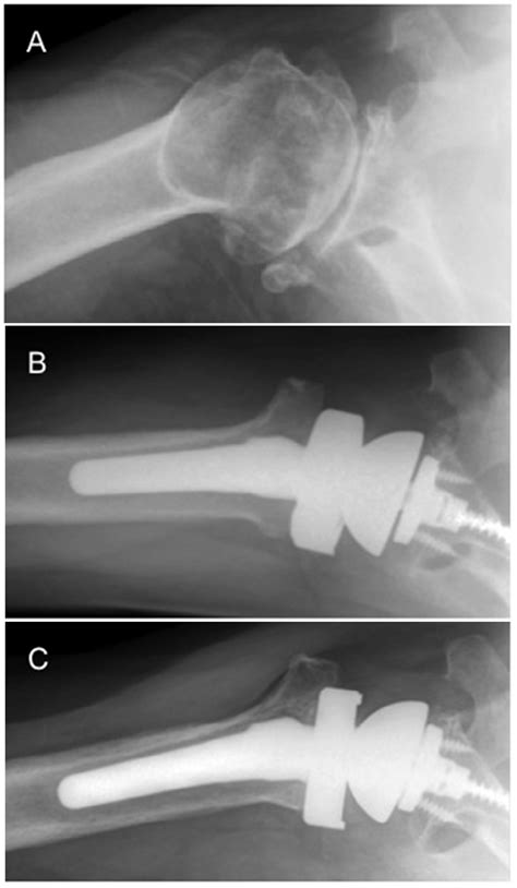 A A 79 Year Old Patient With Posterior Glenoid Erosion B Immediate Download Scientific