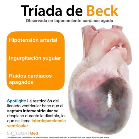Triada De Beck ♥️ Spotlightmed Spotlight Spotlightmedicine 3d4medical Completeheart Beck
