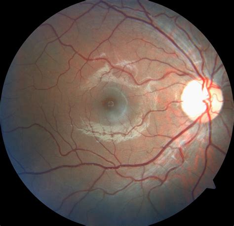 An Example Image For Each Class No Dr Signs Npdr And Pdr Download