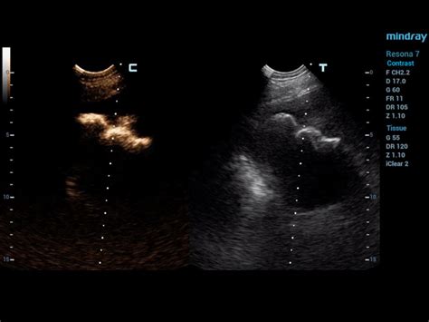 Multi Loculated Liver Abscess Endocavitary Injection Of Diluted