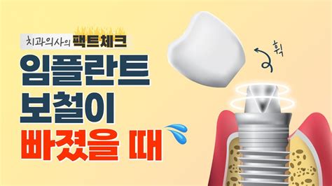 임플란트 보철이 빠지는 이유는 이미 임플란트가 빠졌다면 😱 Youtube