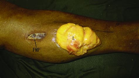 Endoscopically Assisted Resection Of Intramuscular Lipoma Of The Soleus