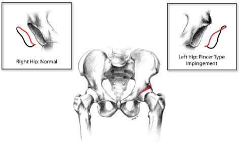 Pincer Impingement May Also Be Caused By Retroversion Of The Acetabulum