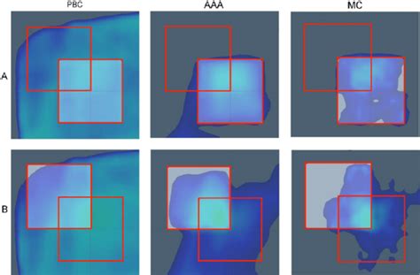 Dose Distributions Calculated Utilizing Pbc First Column Aaa Second