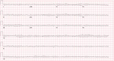 Differential Diagnosis Of Lvad