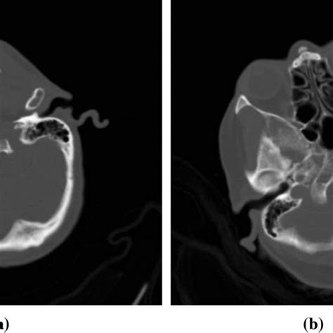 Removing Ring Artifacts In Cbct Images Via Generative Adversarial Networks With Unidirectional