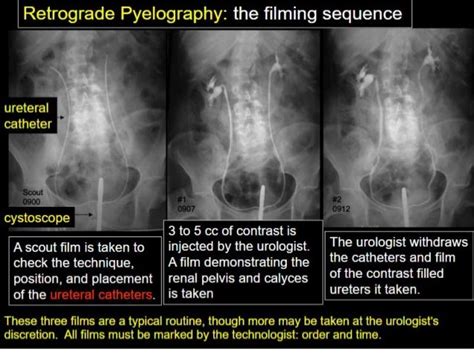 Retrograde Pyelography