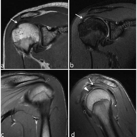 Goutallier Classification 20 Download Table