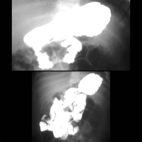 Malrotation With Midgut Volvulus Pediatric Radiology Reference Article Pediatric Imaging