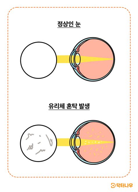 눈앞에 날파리가 보인다면 비문증 의심 증상 원인 치료법에 관해 알아보기 닥터나우