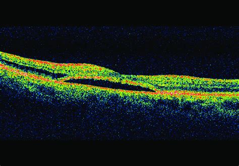 Oct Taken 1 Year After The Surgery Showing Reduction Of The Subretinal Download Scientific
