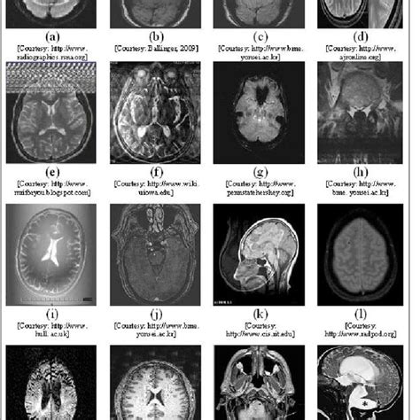 3d Brain Mri Classification