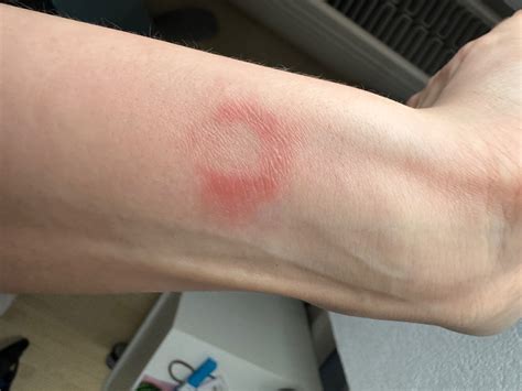 My Apple Watch Sensor Burns Apple Community