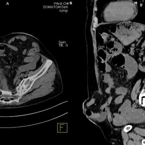 Patients With Parastomal Hernia Repair Download Scientific Diagram