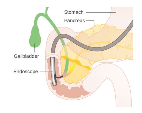 Emergency Medicine Educationcomplications Of Ercp Ed
