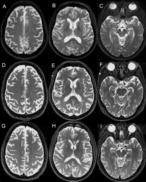 Examples Of Mri Visible Pvs Across The Ad Spectrum Ac A Female Download Scientific Diagram