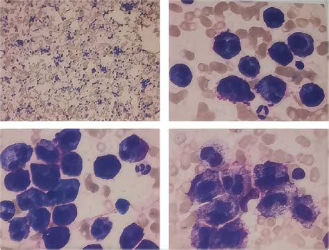 Frontiers Mast Cell Leukemia A Rare Case Report And Literature Review
