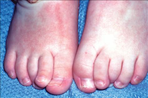 Curved Second Toe Genetic