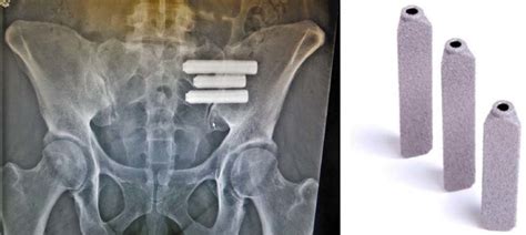 Triangular Titanium Implant With Porous Coating Lateral Approach 25 Download Scientific Diagram