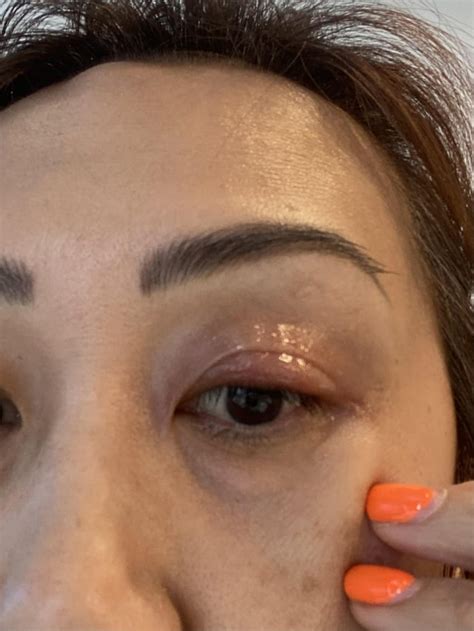 Is This Blepharitis Or A Stye R Blepharitis