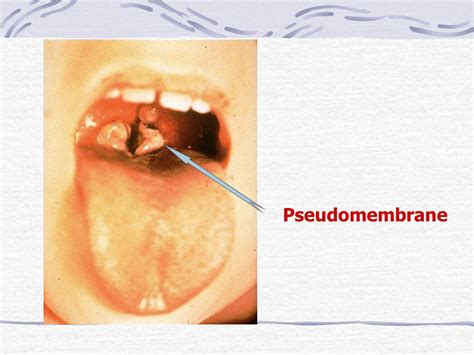 Corynebacterium Diphtheriae Ppt Video Online Download