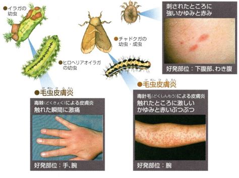夏の虫刺され対策③ 接触タイプ ザクッと時事まとめ