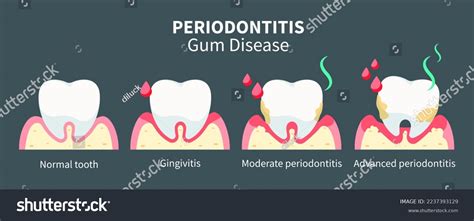 Stages Gum Disease Dental Concept Stage Stock Vector Royalty Free