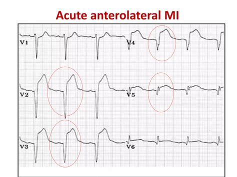 Interpretasi Ekg 12 Leads Infarct And Ischemiapptx