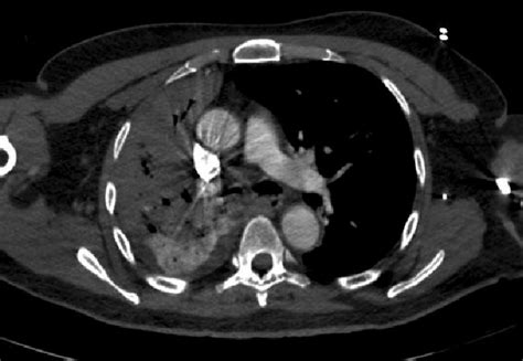 Ct Thorax Right Sided Upper And Mid Zone Collapse Consolidation Download Scientific Diagram