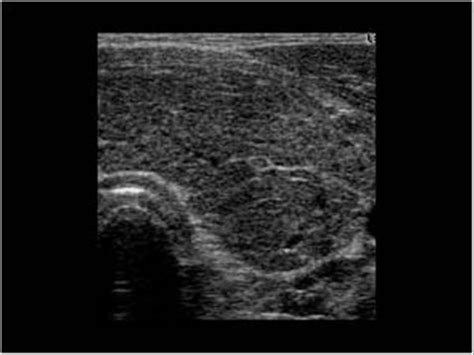 Pediatrics 9 5 Pediatric Head And Neck Case 9 5 2 Thyroid Gland Ultrasound Cases