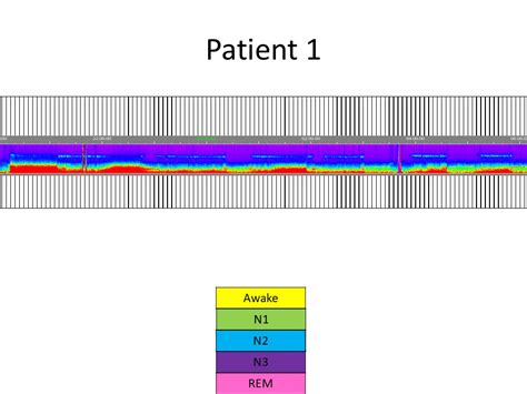 journal rudock et al show that eeg density spectral array can be used