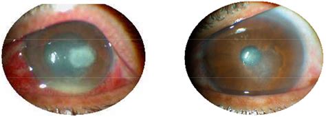 Interstitial Keratitis Medicoappsorg
