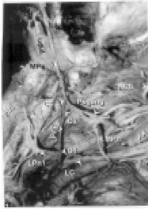 Photograph Of Dissected Axilla Showing Left Brachial Plexus I