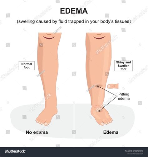 Oedema Swollen Leg Illustration Pitting Edema Stock Illustration