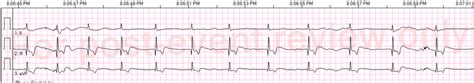 Transcutaneous Pacing Part I