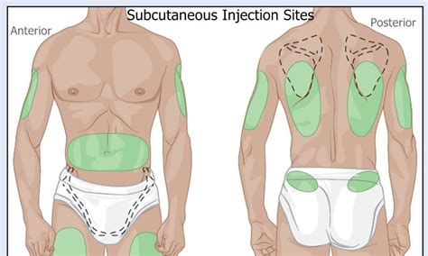 Subcutaneous Injection Is An Effective Method Of Drug Delivery That Is Used Quite Frequently In