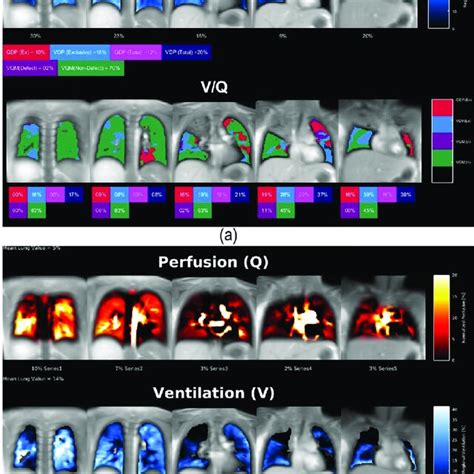 Impact On Functional Lung Values Caused By The Improvements In