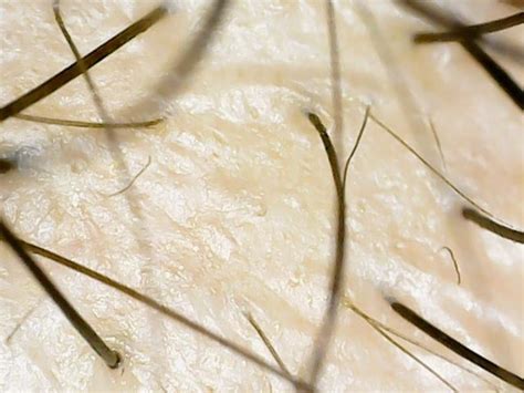 Observing Scalp Under Microscope New Growth Or Aga Miniaturization Femalehairloss