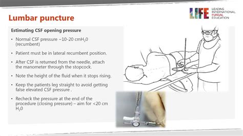 How To Measure Csf Pressure At David Davis Blog