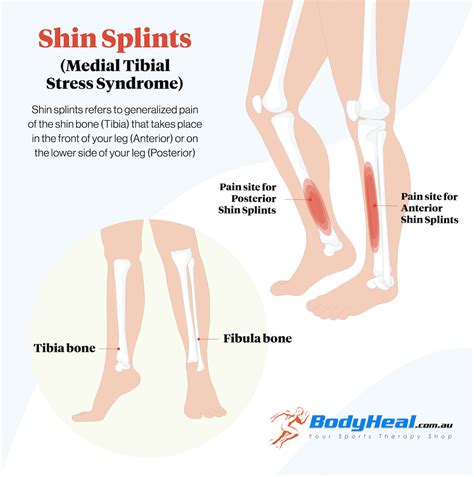 Anterior Tibialis Shin Splints
