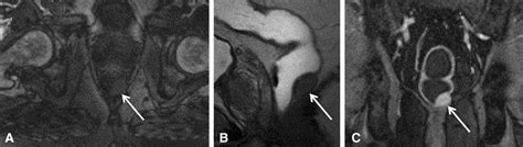 Surgically Proven Distal Rectal Gist A Axial T1 Weighted Image Shows A